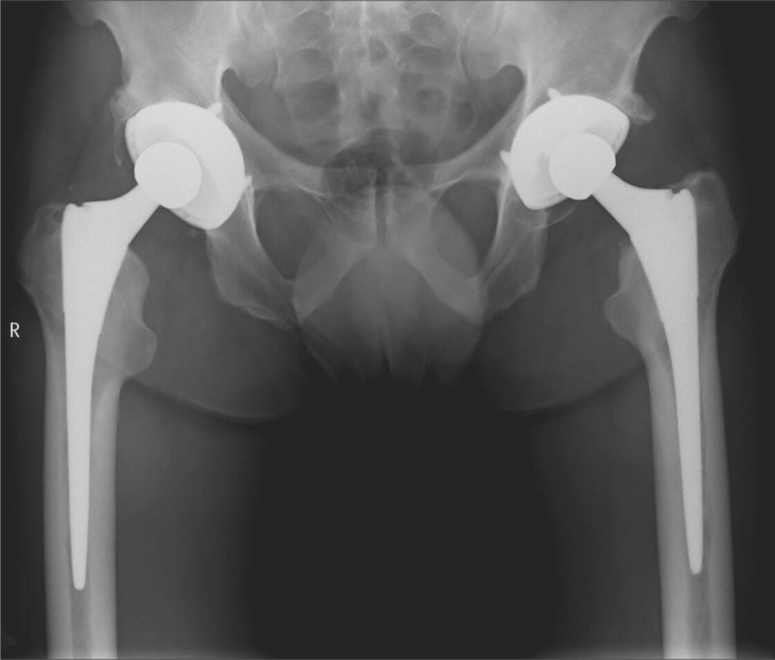 What Does a Hip Replacement in a Child Entail? - Global Sound Authority