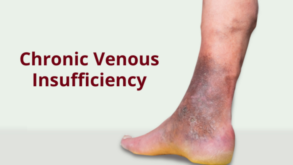 How to Manage Chronic Venous Insufficiency - Global Sound Authority